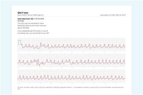 What Ventricular Tachycardia Vtach Looks Like On Your Watch Ecg Qaly