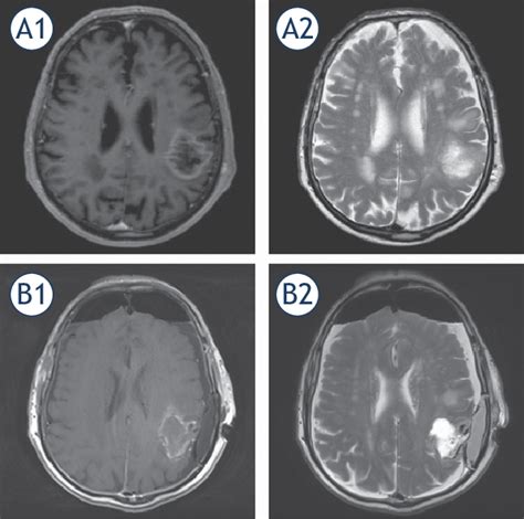 Preoperative A And Postoperative B T1 Weighted Contrast Enhanced