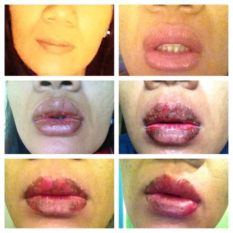 Allergic Reaction To Lip Balm Treatment Quotes Today