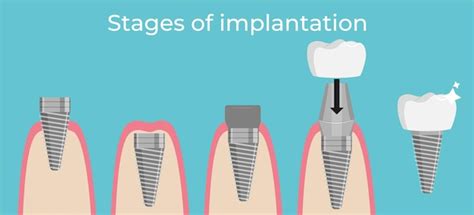 Les étapes De La Pose D un Implant Dentaire Illustration Vectorielle