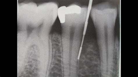 Evaluaci N De La P Rdida Sea Dental Por Radiograf A Blog Dental Irriak