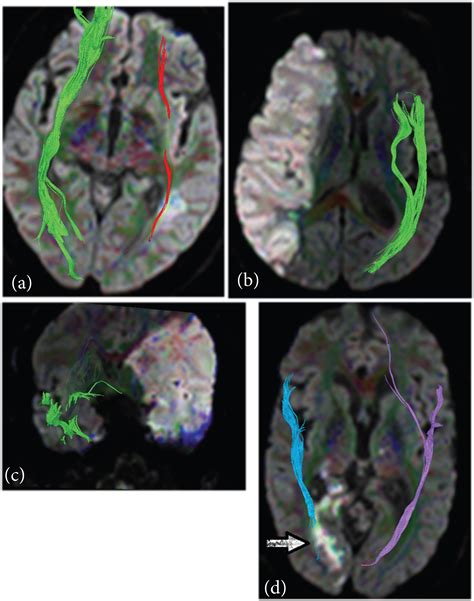 The Role Of The Diffusion Tensor Imaging And The MR Tractography In The