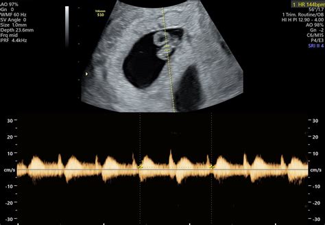 O que se avalia e a importância do ultrassom obstétrico de primeiro