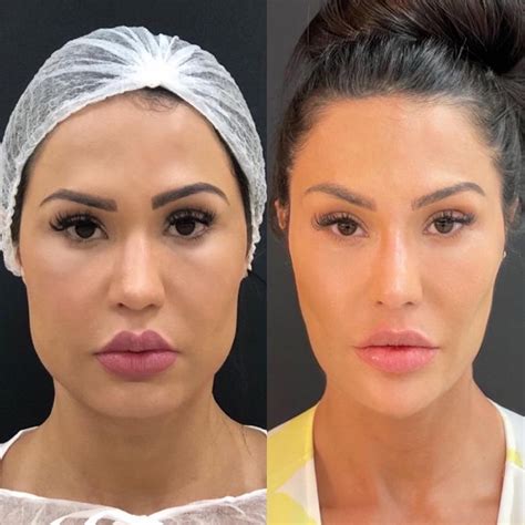 Veja Como Ficou O Rosto De Gracyanne Barbosa Ap S Harmoniza O Facial
