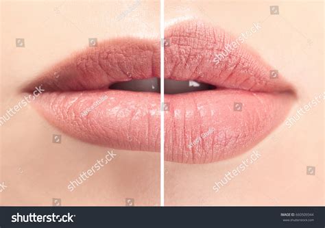 Female Lips Before After Augmentation Procedure Stock Photo 660509344