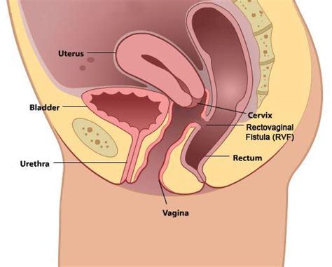 Having Sex With A Vaginal Fistula Porn Tube Comments
