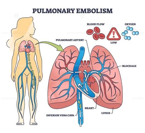 Pulmonary Embolism With Blood Flow Blockage In Lung Artery Outline