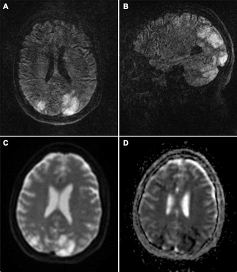 Resonancia magnética RM cerebral en la secuencia T2 FLAIR en su