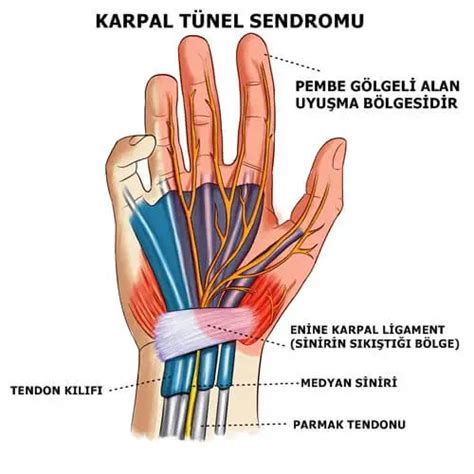 Karpal Tünel Sendromu Nedir Belirtileri ve Tedavisi