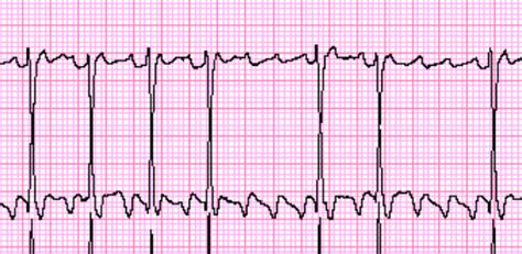 Variable Av Conduction Ecg Made Simple