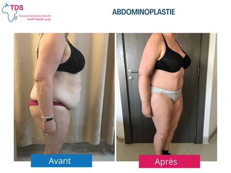 Abdominoplastie Tunisie Prix Chirurgie Du Ventre Tout Compris