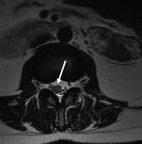 Cauda Equina Thickening An Approach To Mri Findings Clinical Radiology