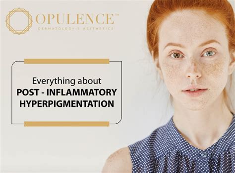 EVERYTHING ABOUT POST INFLAMMATORY HYPERPIGMENTATION Opulence