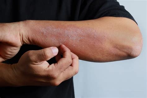 Manchas rojas en la piel 19 causas y cómo quitarlas Tua Saúde