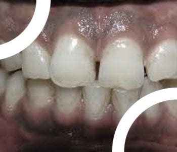 Chirurgie Dentaire Cas Des Gencives Noires Dentiste Ari Elhyani