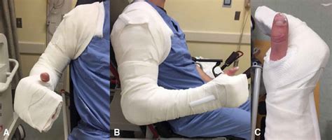 Radial Nerve Anatomy Radial Nerve Palsy And Radial Nerve Injury
