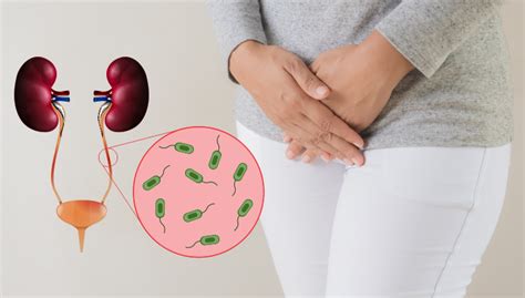 INFECÇÃO URINÁRIA O QUE É E COMO PREVENIR CM Martins