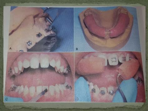 Bonding In Orthodontics Ppt