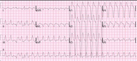 Dr Smith S ECG Blog Wide Complex Tachycardia Refractory To Anti