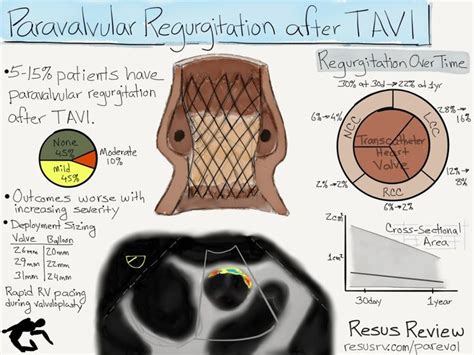 Que Es Un Tavi Cardiologia Inhealthvlaanderen