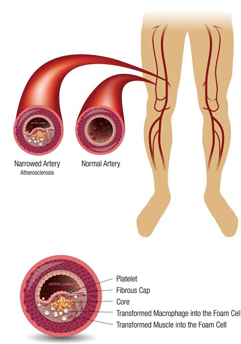 Efemoral Medical Peripheral Vascular Disease