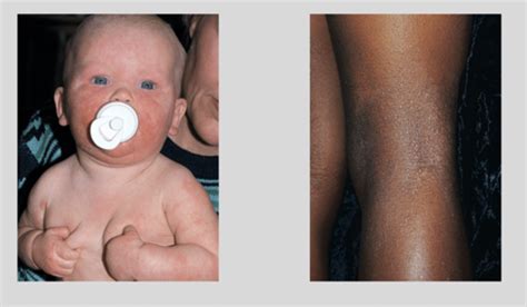 Flashcards Papulosquamous Disorders And Dermatitis Quizlet