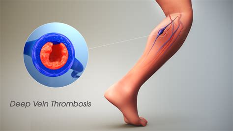 Deep Vein Thrombosis Symptoms Causes And Treatment