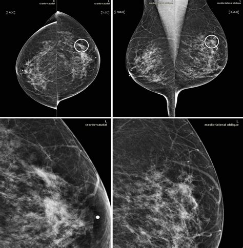 new artificial intelligence tool improves breast cancer detection on mammography