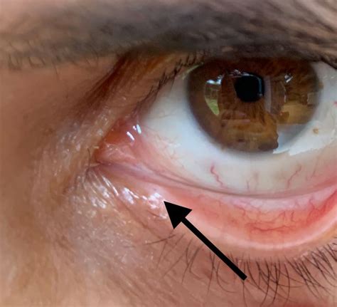 List Pictures What Does A Swollen Tear Duct Look Like Sharp