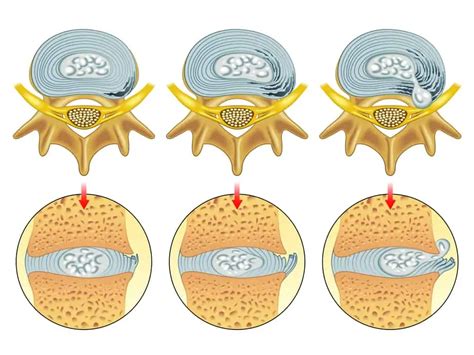 Exercises To Avoid With A Lumbar Herniated Disc EMPOWER YOURWELLNESS