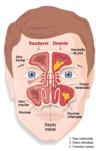 O que é sinusite GUIA completo dos sintomas ao tratamento