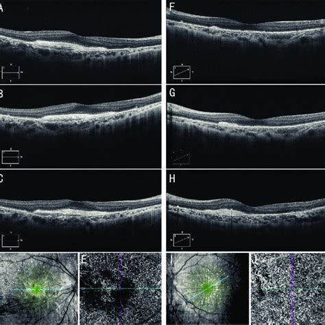 Optical Coherence Tomography OCT And Optical Coherence Tomography