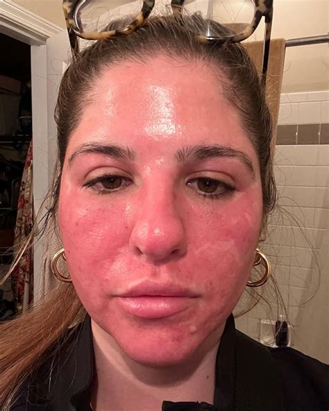 CO2 Resurfacing Laser Before During After RMA