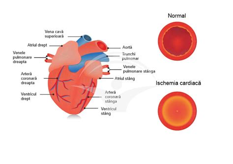 Ischemia Cardiaca Cauze Simptome Si Tratament