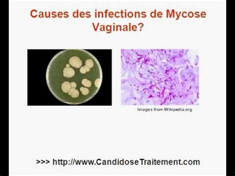 Mycose Vaginale Mycoses Vaginales Youtube