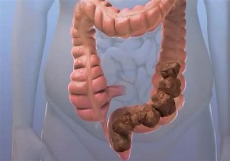 CONSTIPAÇÃO INTESTINAL O que é e orientações Dr Fernando Bray