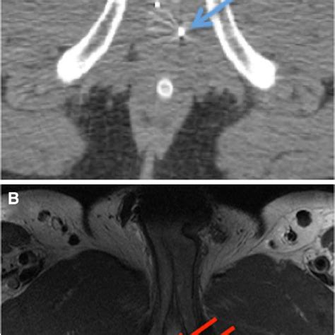 Axial CT Image After Placement Of Brachytherapy Seeds In The Prostate