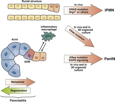 Carcinogenesis Of Pancreatic Ductal Adenocarcinoma Gastroenterology