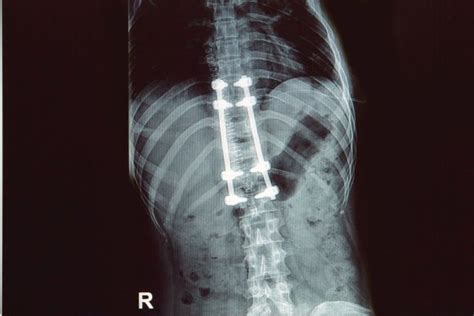Spinal Fusion Instrumentation Removal Pros And Cons Spinal Fusion