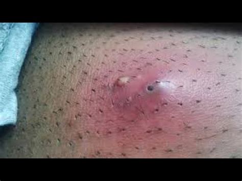Popping Huge BlackHeads Popping Giant Pimples Best Popping Videos