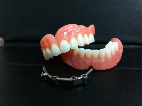 Prothèses dentaires sur implant Clinique de Denturologie Landry Lavertu
