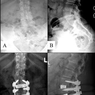 Preoperative Anteroposterior AP A And Lateral B Radiographs And