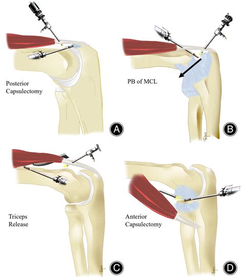 Sequence Of Arthroscopic Arthrolysis For Soft Tissue Related Stiff