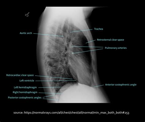 Lateral View Chest X Ray Anatomy