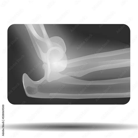 X Ray Of Fracture Ankle Bone Fla Source File Available Fracture