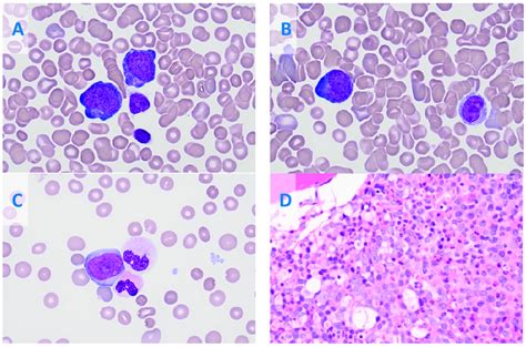Bone Marrow Aspirate Smears Show Increased Leukemic Blasts 20 5 The