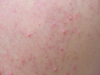Pruritic Urticarial Papules And Plaques Of Pregnancy First Trimester