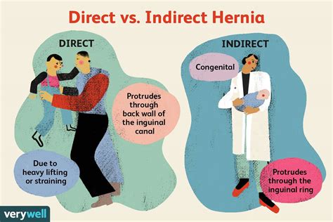 Indirect Vs Direct Inguinal Hernia