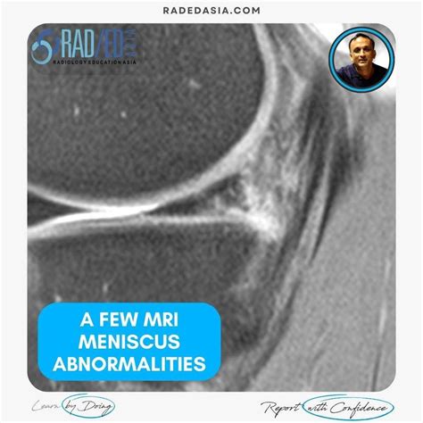 A FEW MRI MENISCUS ABNORMALITIES MENISCUS TEAR INTRA MENISCAL CYST