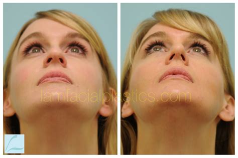 Before And After Rhinoplasty Rhinoplasty Nosejob Dallas